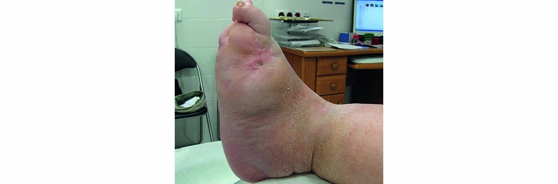 Neuroosteoartropatia Charcota w codziennej praktyce - Choroby ...