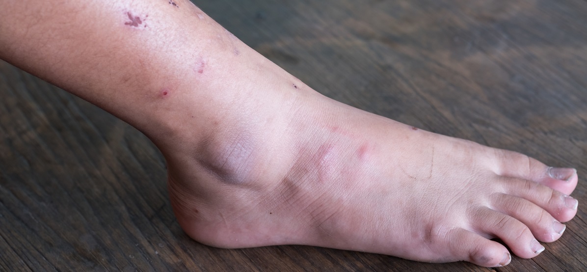 Zespół stopy cukrzycowej – krótka powtórka nie tylko dla diabetologów ...